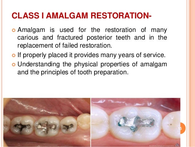 Do Amalgam Restoration On 30
