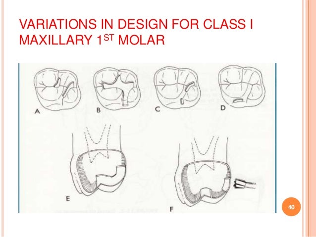 Class i cavity preparation