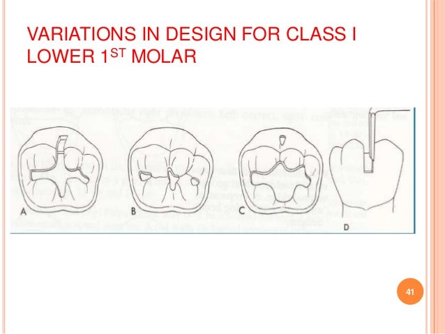 Class i cavity preparation
