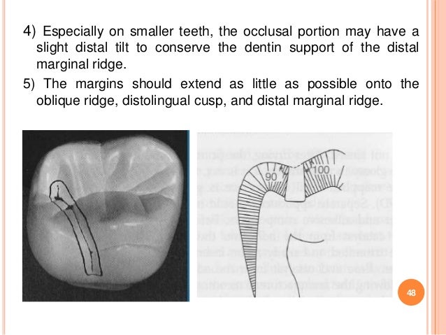 Class i cavity preparation