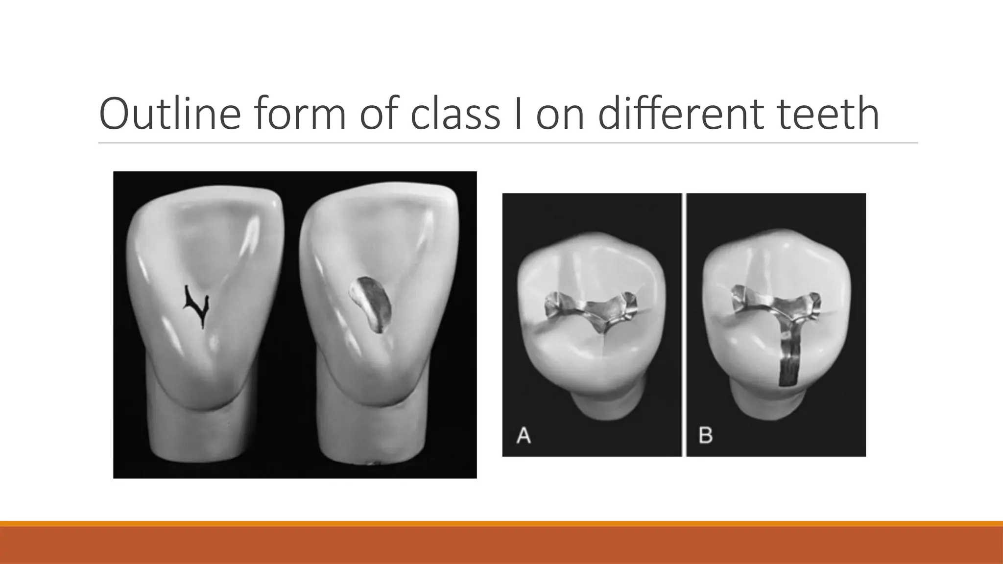 Class I cavity preparation for Amalgam.pptx
