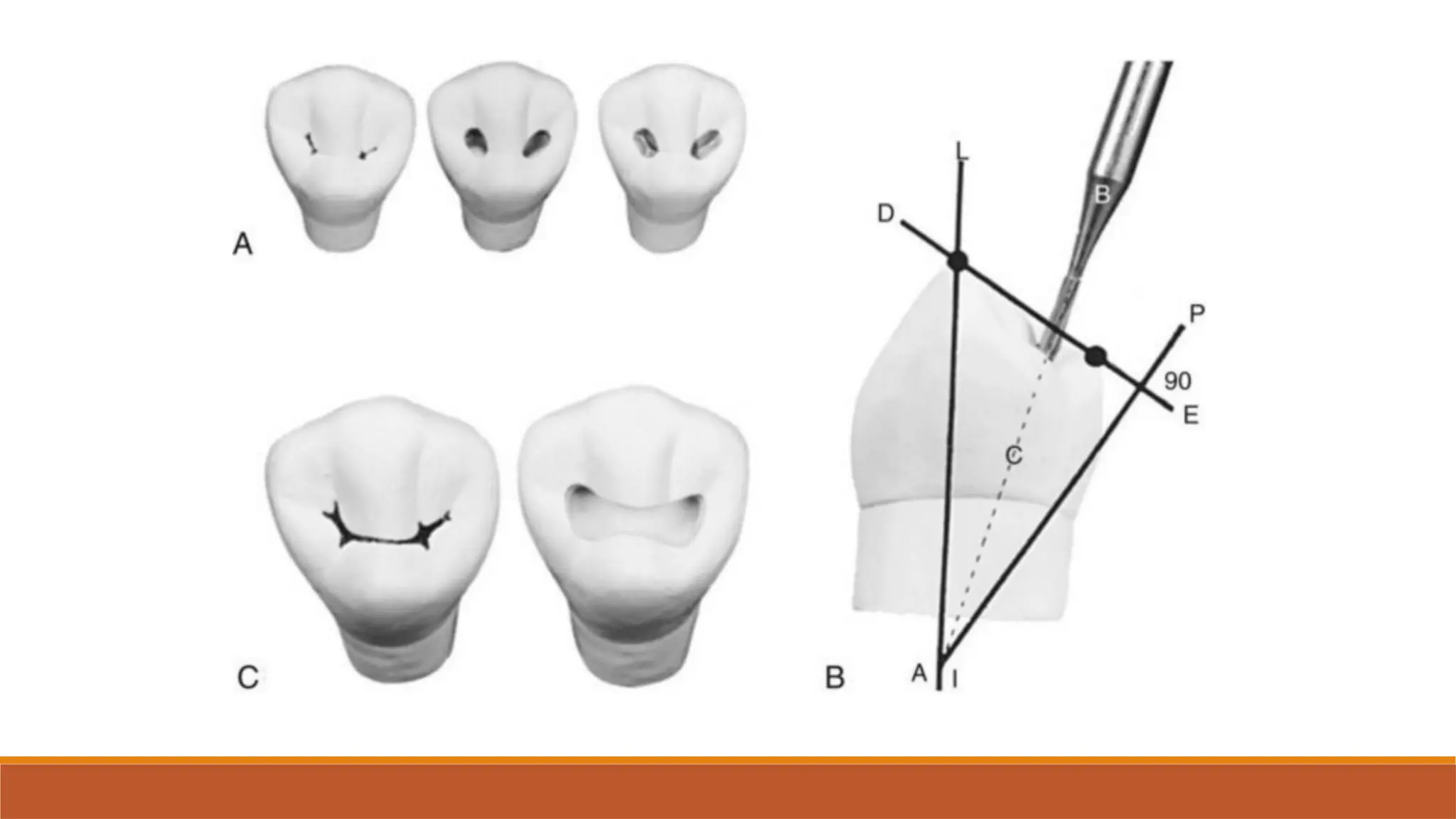 Class I cavity preparation for Amalgam.pptx