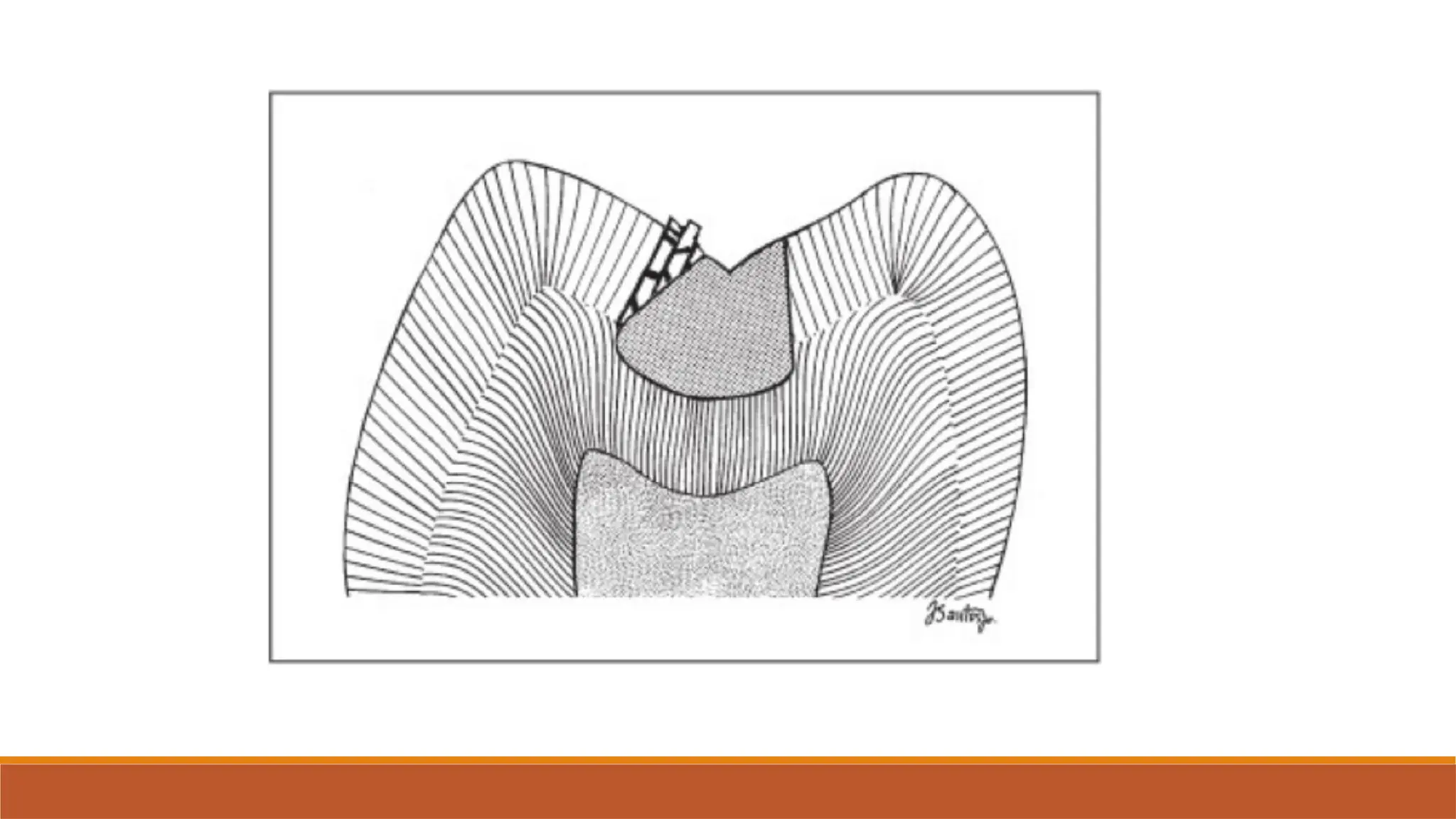 Class I cavity preparation for Amalgam.pptx