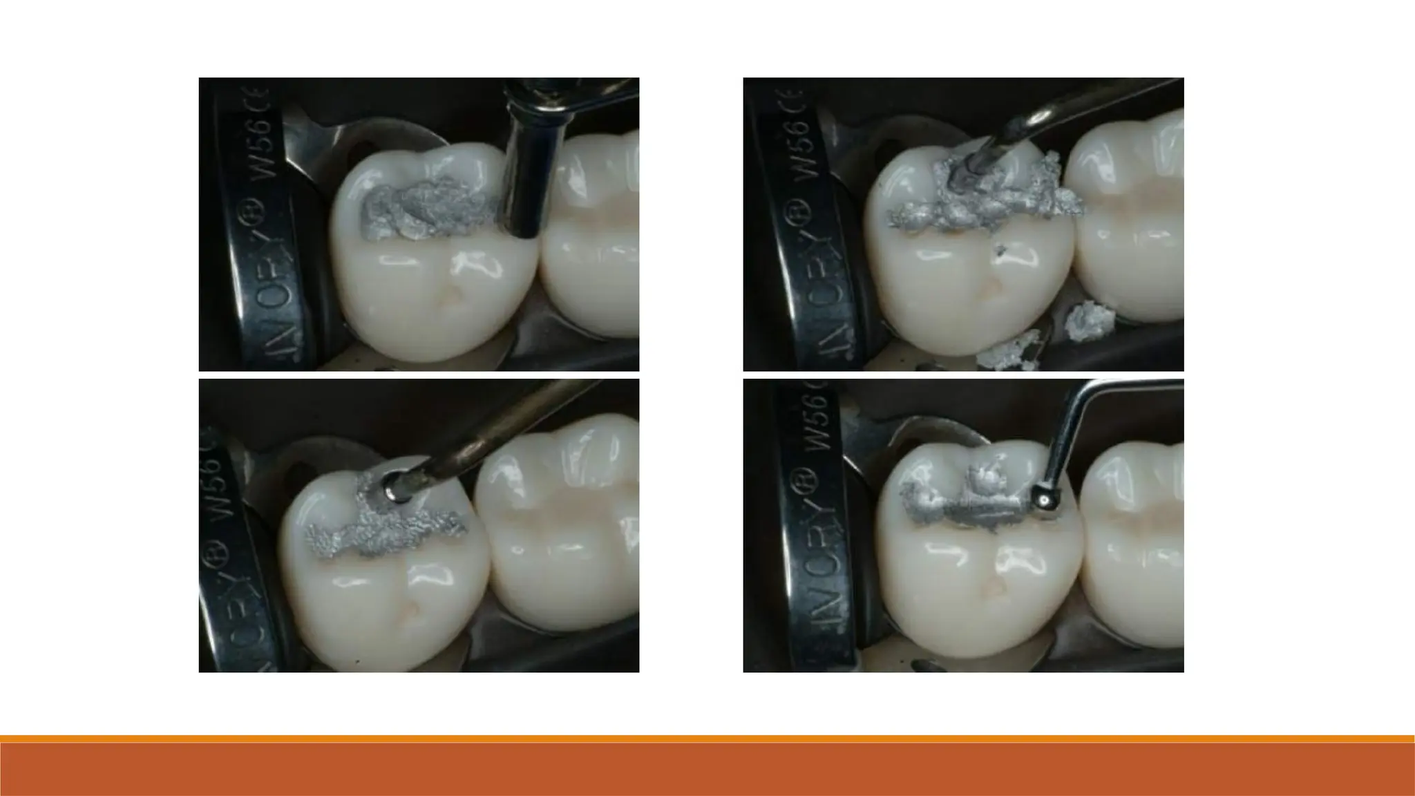 Class I cavity preparation for Amalgam.pptx