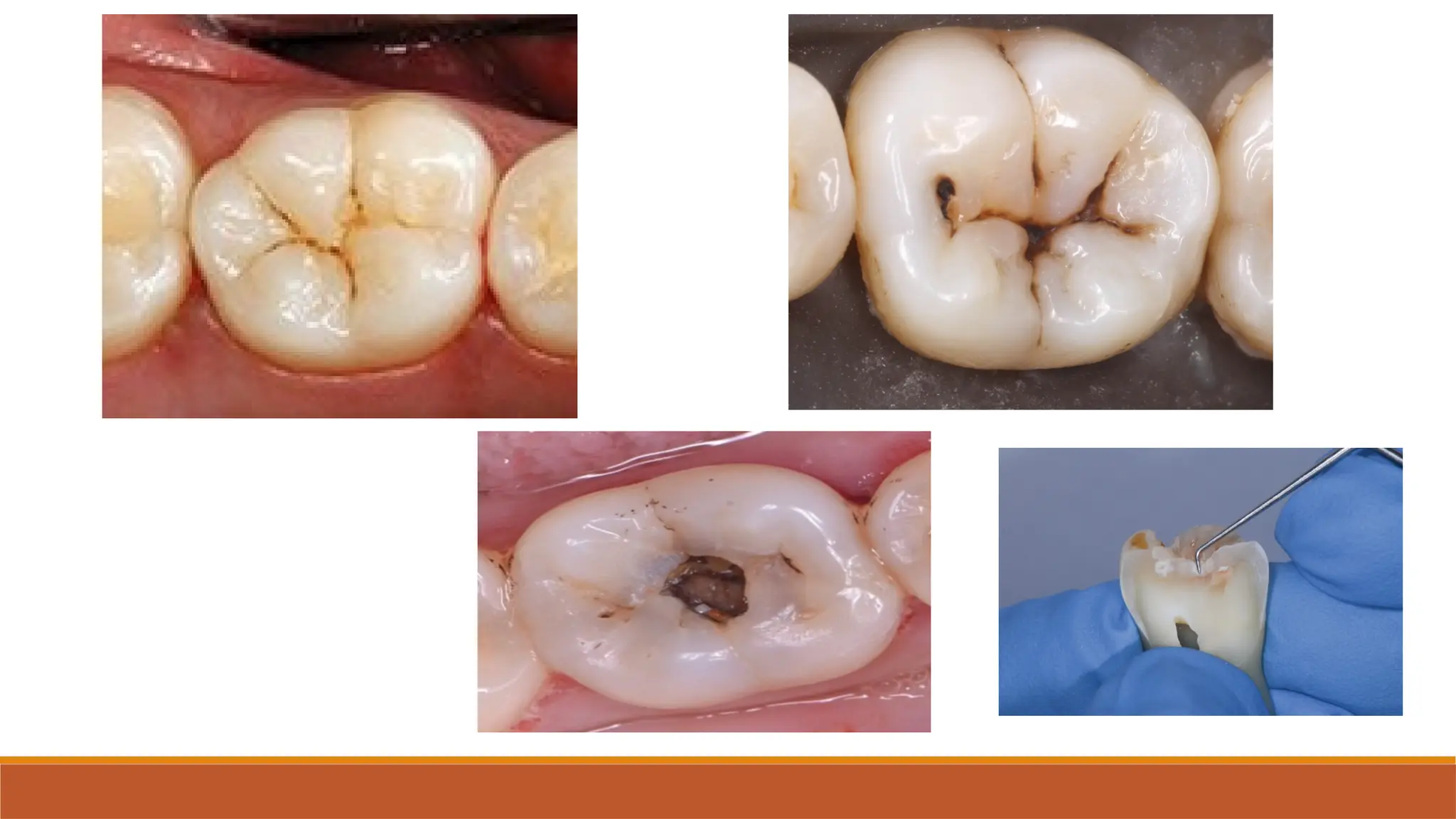 Class I cavity preparation for Amalgam.pptx