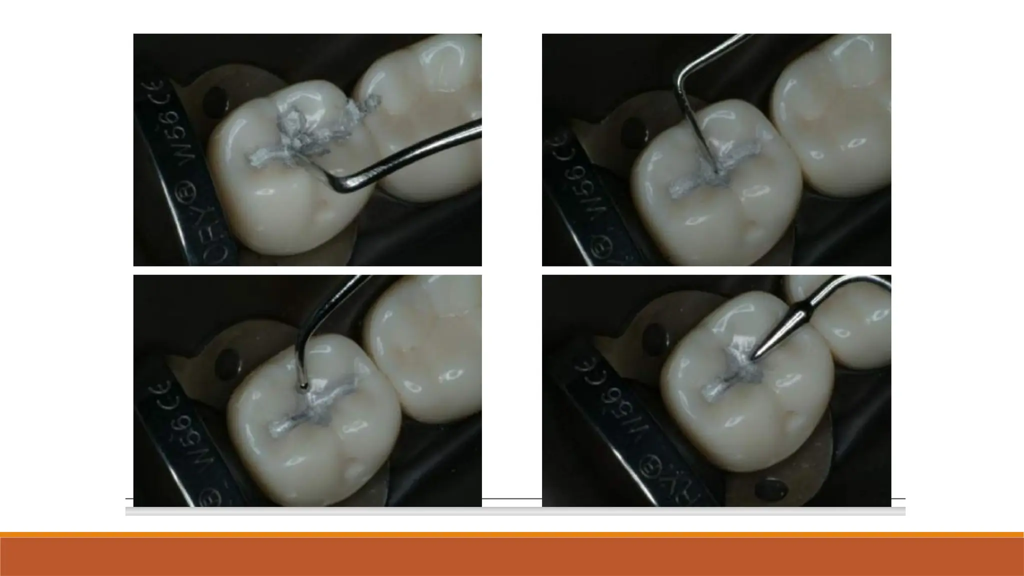 Class I cavity preparation for Amalgam.pptx