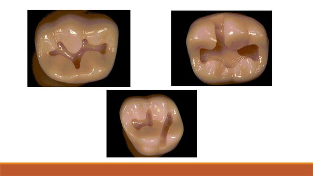 Class I cavity preparation for Amalgam.pptx | Dental Health | Diseases ...