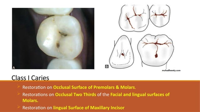 Class I cavity preparation for Amalgam.pptx | Dental Health | Diseases ...