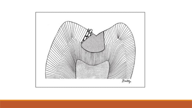Class I cavity preparation for Amalgam.pptx | Dental Health | Diseases ...