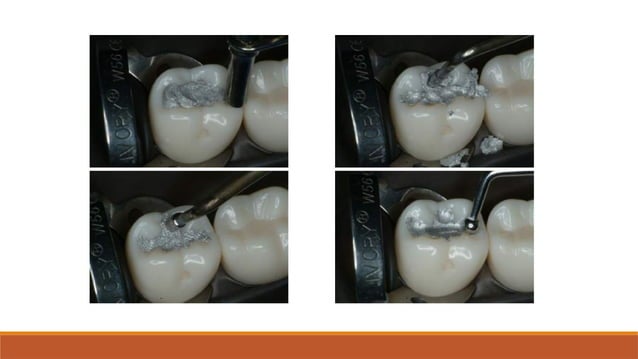Class I cavity preparation for Amalgam.pptx | Dental Health | Diseases ...
