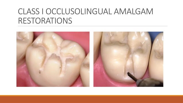 Class I cavity preparation for Amalgam.pptx | Dental Health | Diseases and Conditions