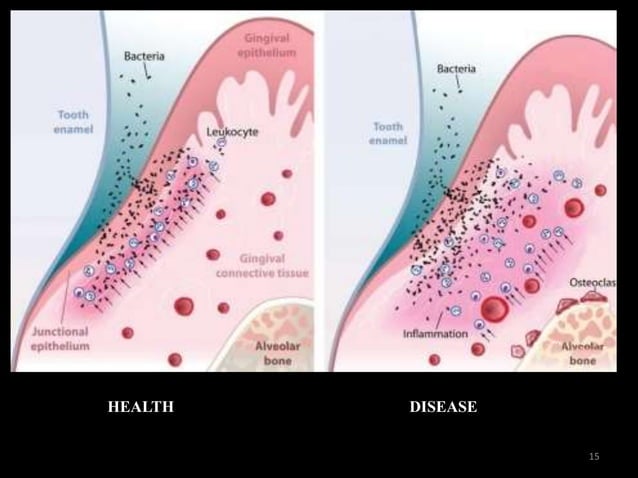 AAP 2017 CLASSIFICATION OF PERIODONTAL DISEASE PART 1 | PPTX | Dental ...