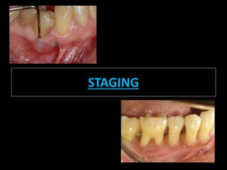 AAP 2017 CLASSIFICATION OF PERIODONTAL DISEASE PART 1 | PPTX
