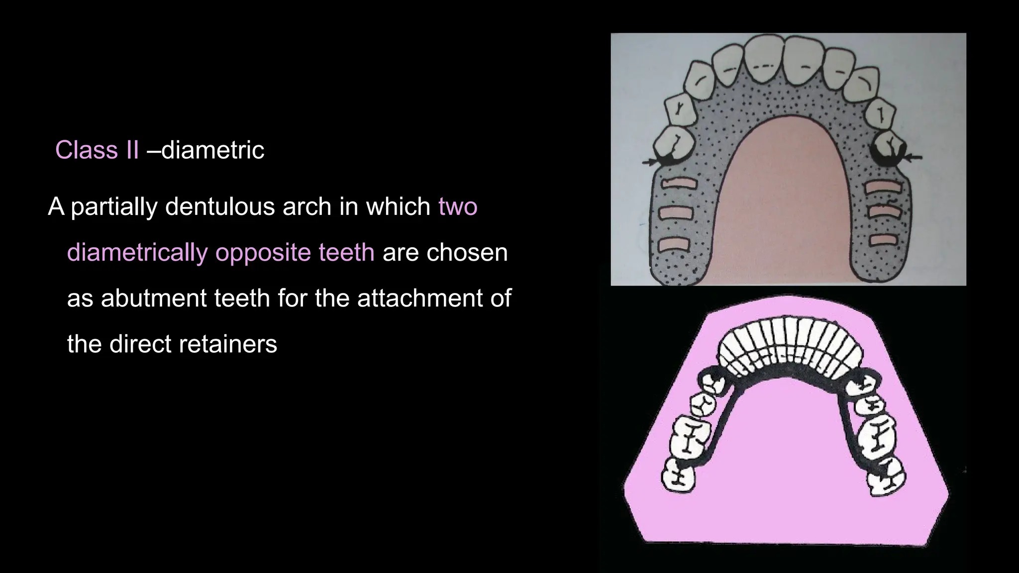 classifctn of RPD .pptx