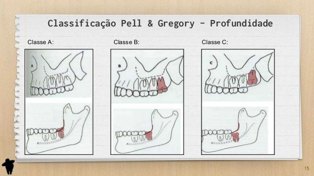 Classificação de Winter e Classificação Pell e Gregory - Cirurgia Buc…