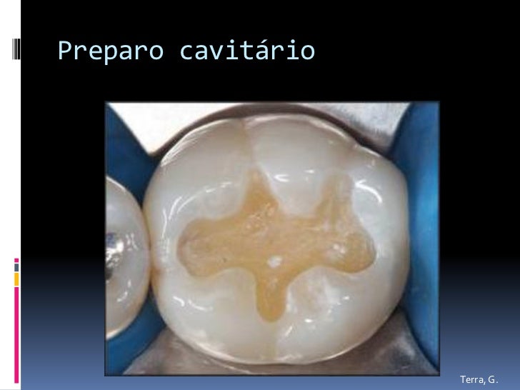 Classificações das resinas compostas, preparo cavitário e restauração…
