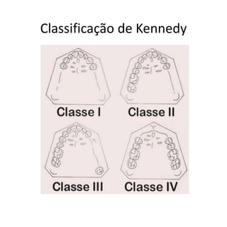 Classificação de Kennedy - Resumo Concurso Odontologia.pdf