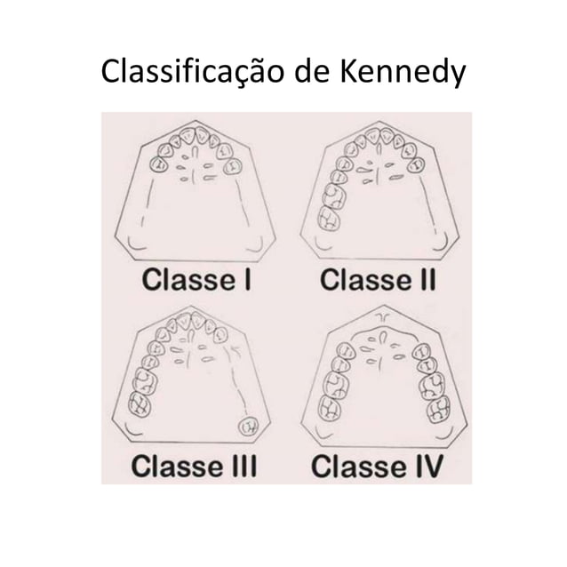 Classificação de Kennedy - Resumo Concurso Odontologia.pdf