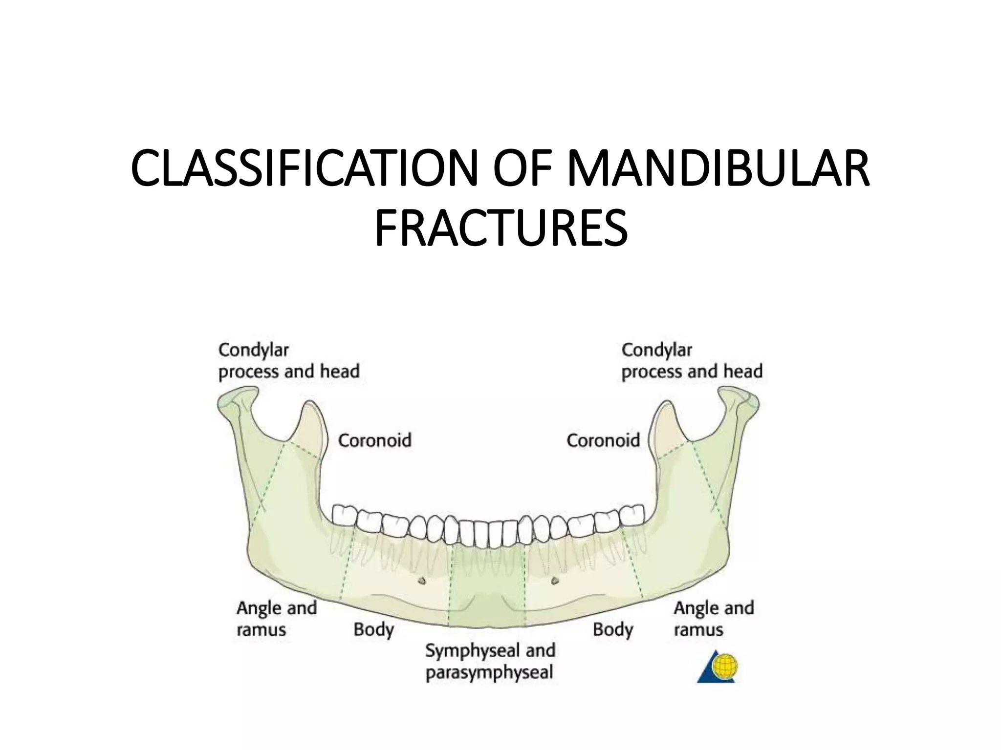Classification of Mandible, Midface, ZMC and NOE Fractures | PPTX