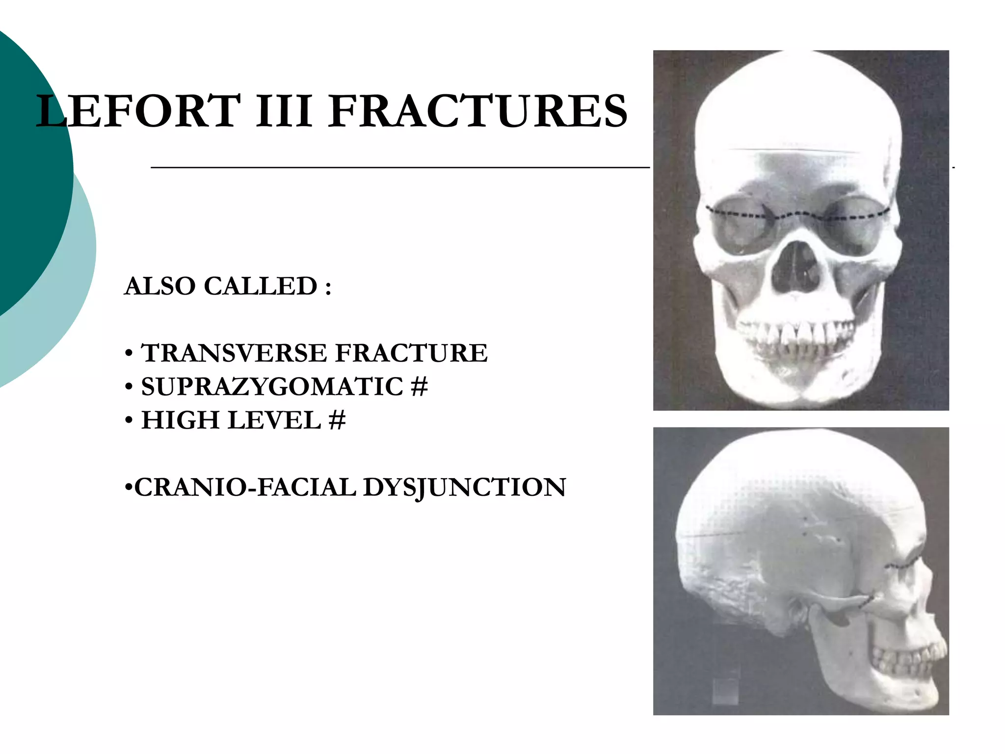 Classification of Mandible, Midface, ZMC and NOE Fractures | PPTX