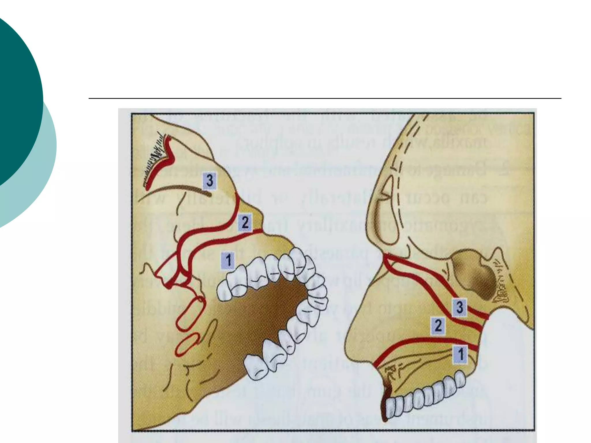 Classification of Mandible, Midface, ZMC and NOE Fractures | PPTX