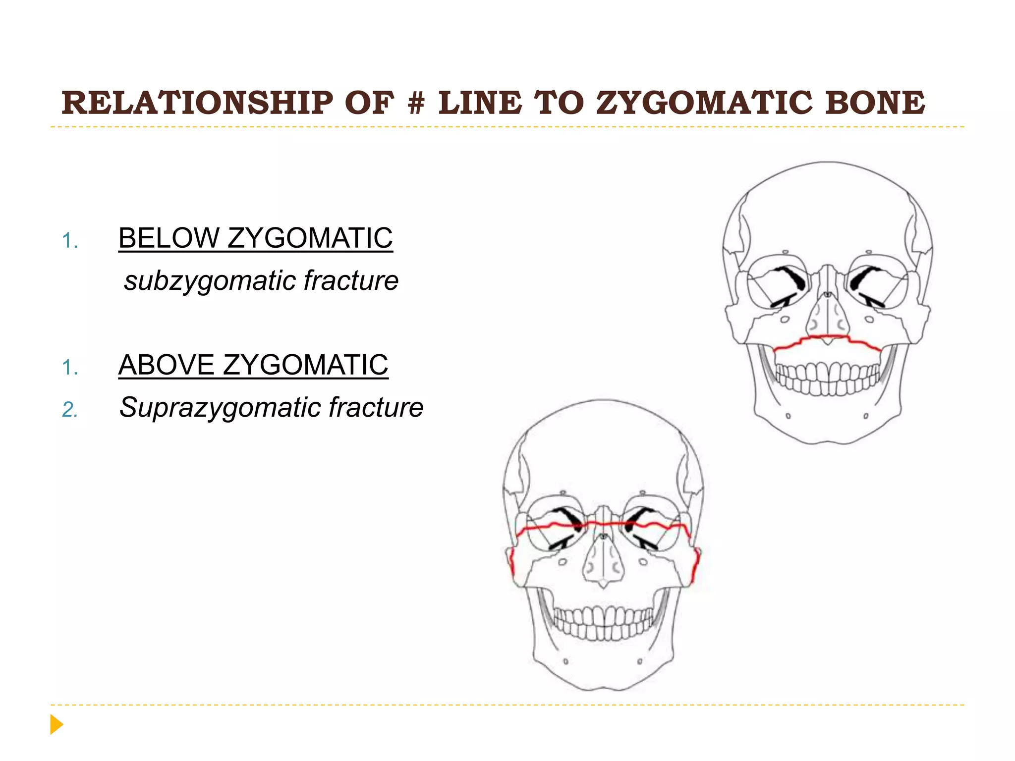 Classification of Mandible, Midface, ZMC and NOE Fractures | PPTX