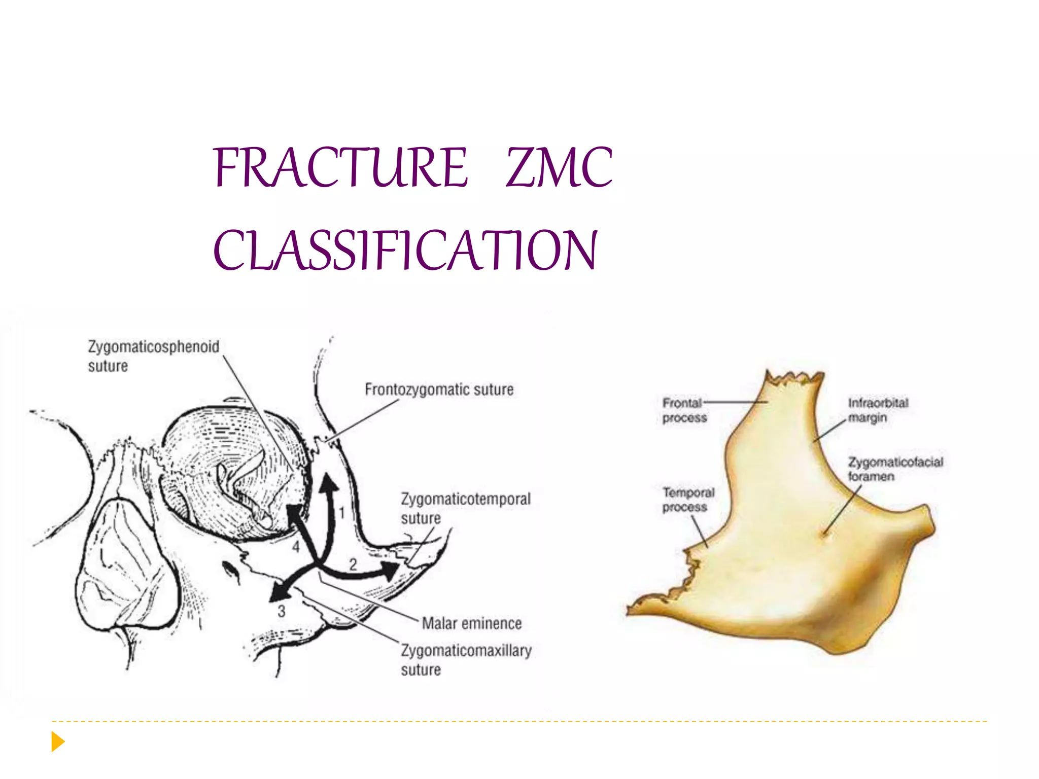Classification of Mandible, Midface, ZMC and NOE Fractures | PPTX ...
