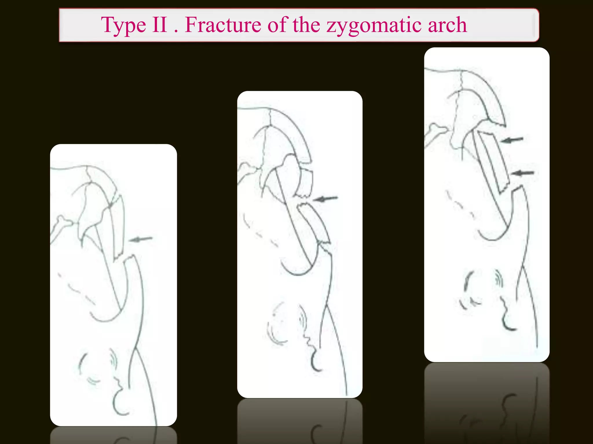 Classification of Mandible, Midface, ZMC and NOE Fractures | PPTX