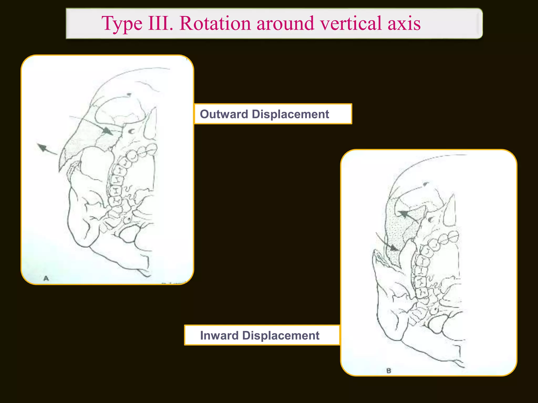 Classification of Mandible, Midface, ZMC and NOE Fractures | PPTX