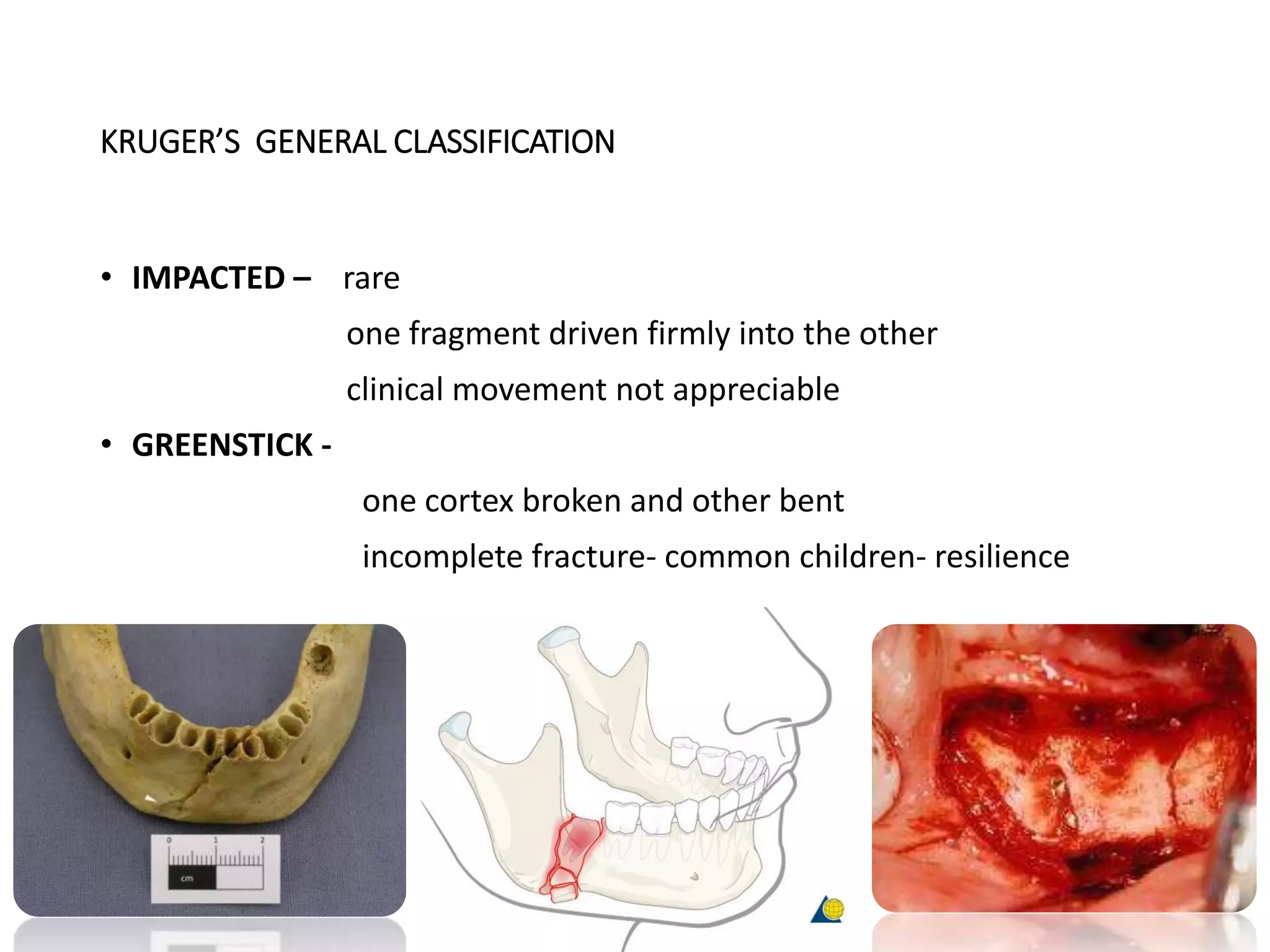 Classification of Mandible, Midface, ZMC and NOE Fractures | PPTX
