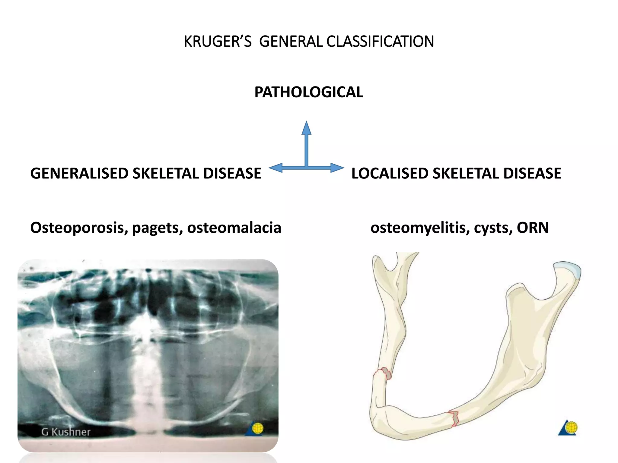 Classification of Mandible, Midface, ZMC and NOE Fractures | PPTX