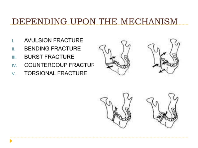 Classification of Mandible, Midface, ZMC and NOE Fractures | PPTX ...