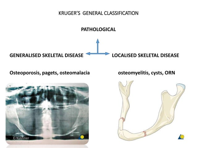 Classification of Mandible, Midface, ZMC and NOE Fractures | PPTX ...