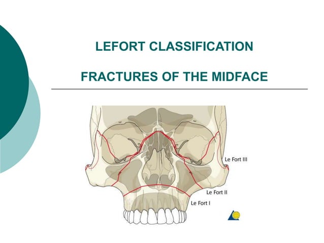Classification of Mandible, Midface, ZMC and NOE Fractures