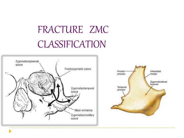 Classification of Mandible, Midface, ZMC and NOE Fractures