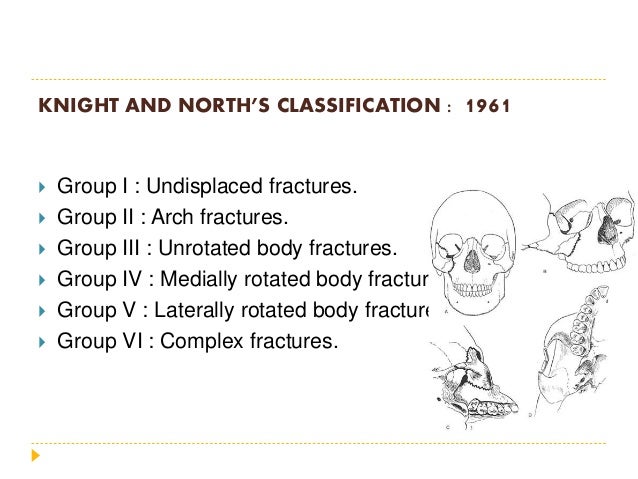 Classification of Mandible, Midface, ZMC and NOE Fractures