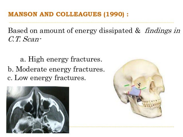 Classification of Mandible, Midface, ZMC and NOE Fractures