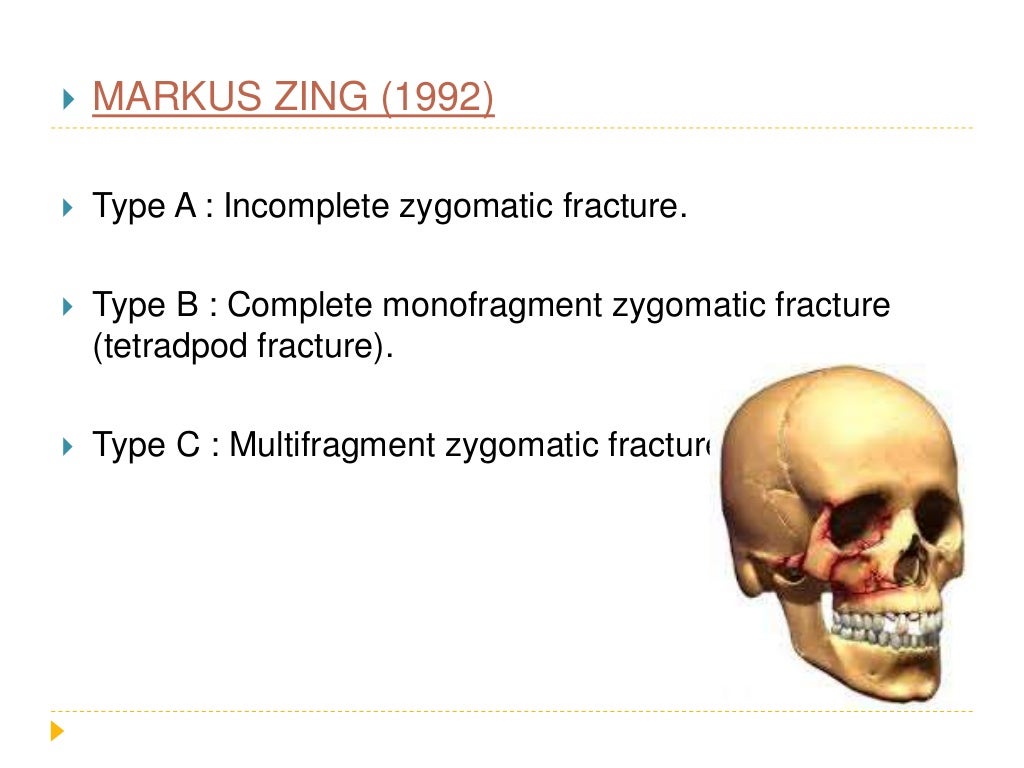 Classification of Mandible, Midface, ZMC and NOE Fractures