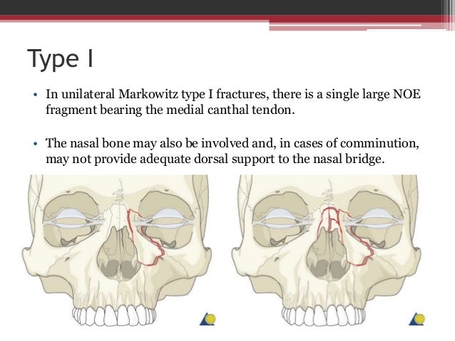 Classification Of Mandible Midface Zmc And Noe Fractures
