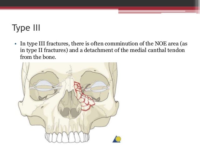 Classification of Mandible, Midface, ZMC and NOE Fractures