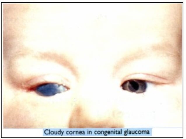 Classification of Glaucoma | PPT