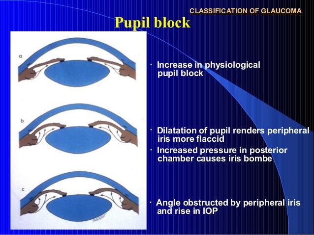 Classification of Glaucoma