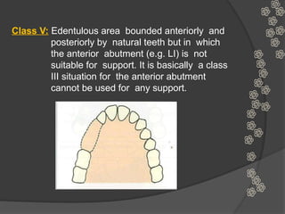 Classification of edentulous arches.pptx