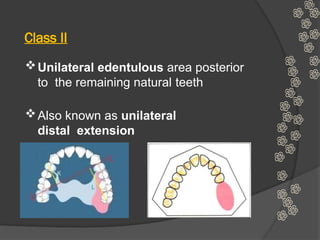 Classification of edentulous arches.pptx