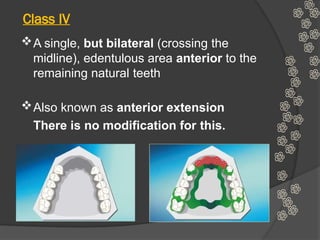 Classification of edentulous arches.pptx