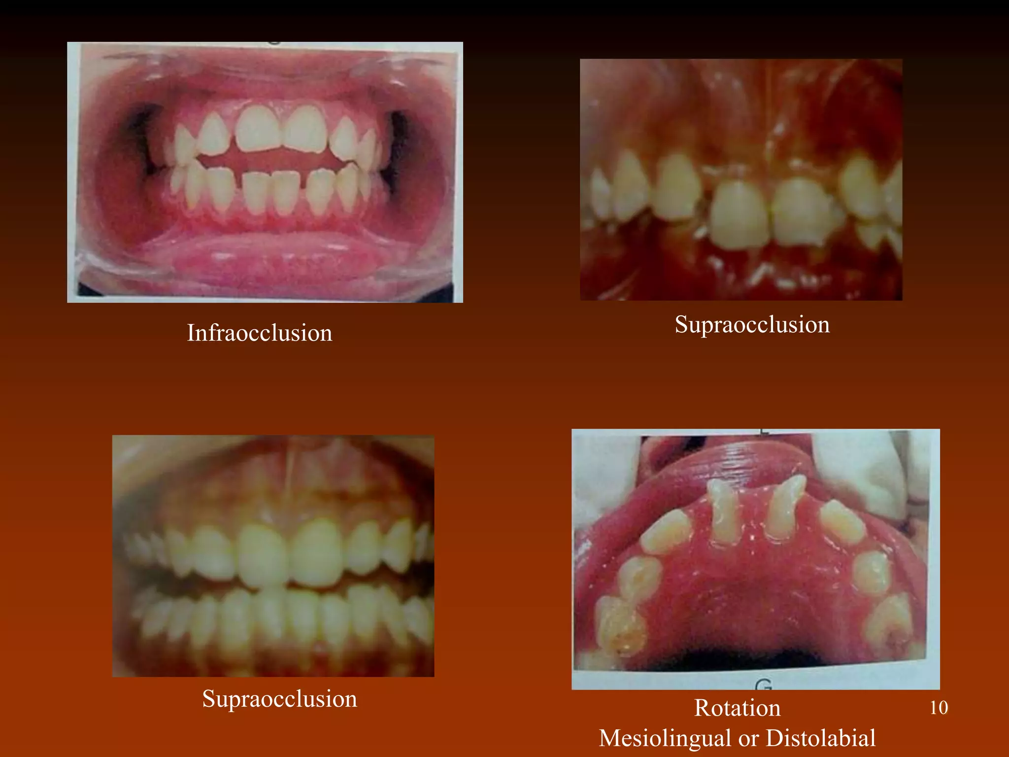 Classification-of-Malocclusion O.ppt