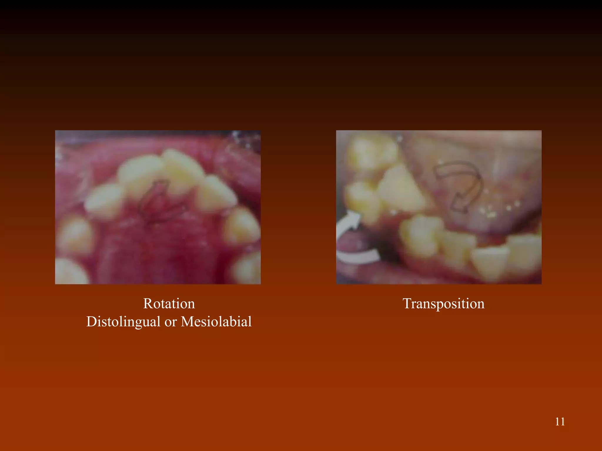 Classification-of-Malocclusion O.ppt
