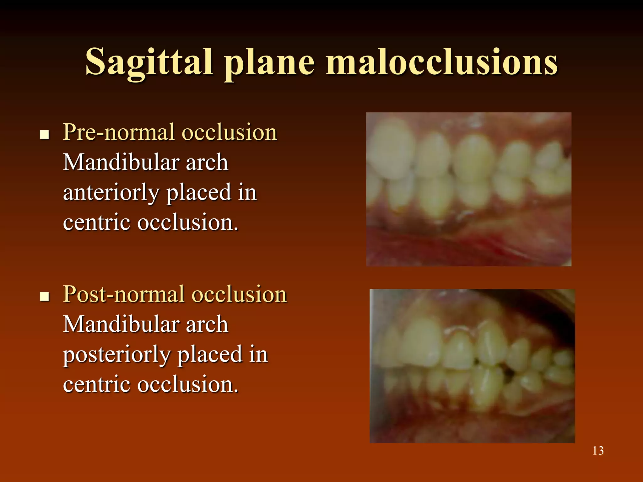 Classification-of-Malocclusion O.ppt