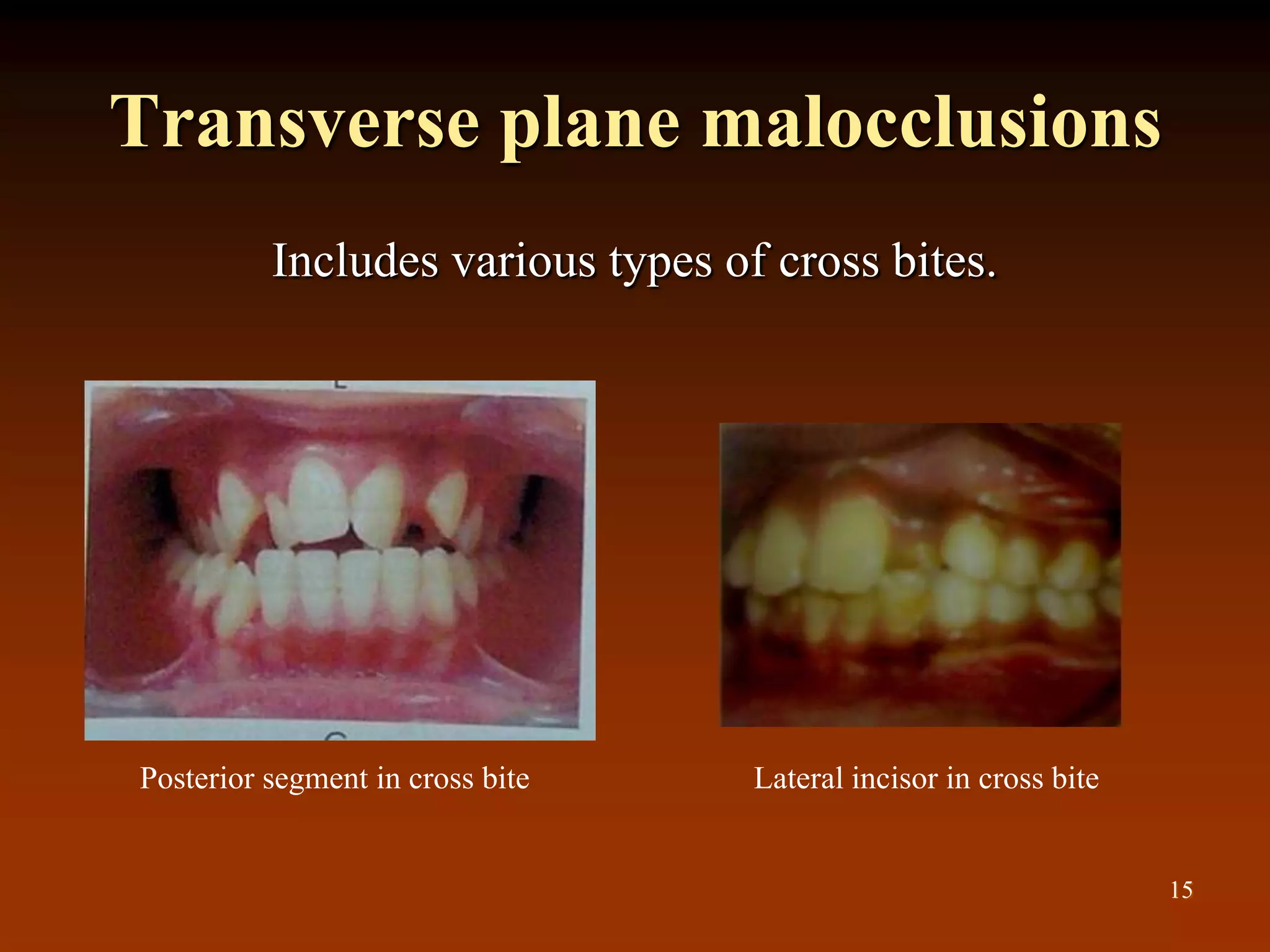 Classification-of-Malocclusion O.ppt