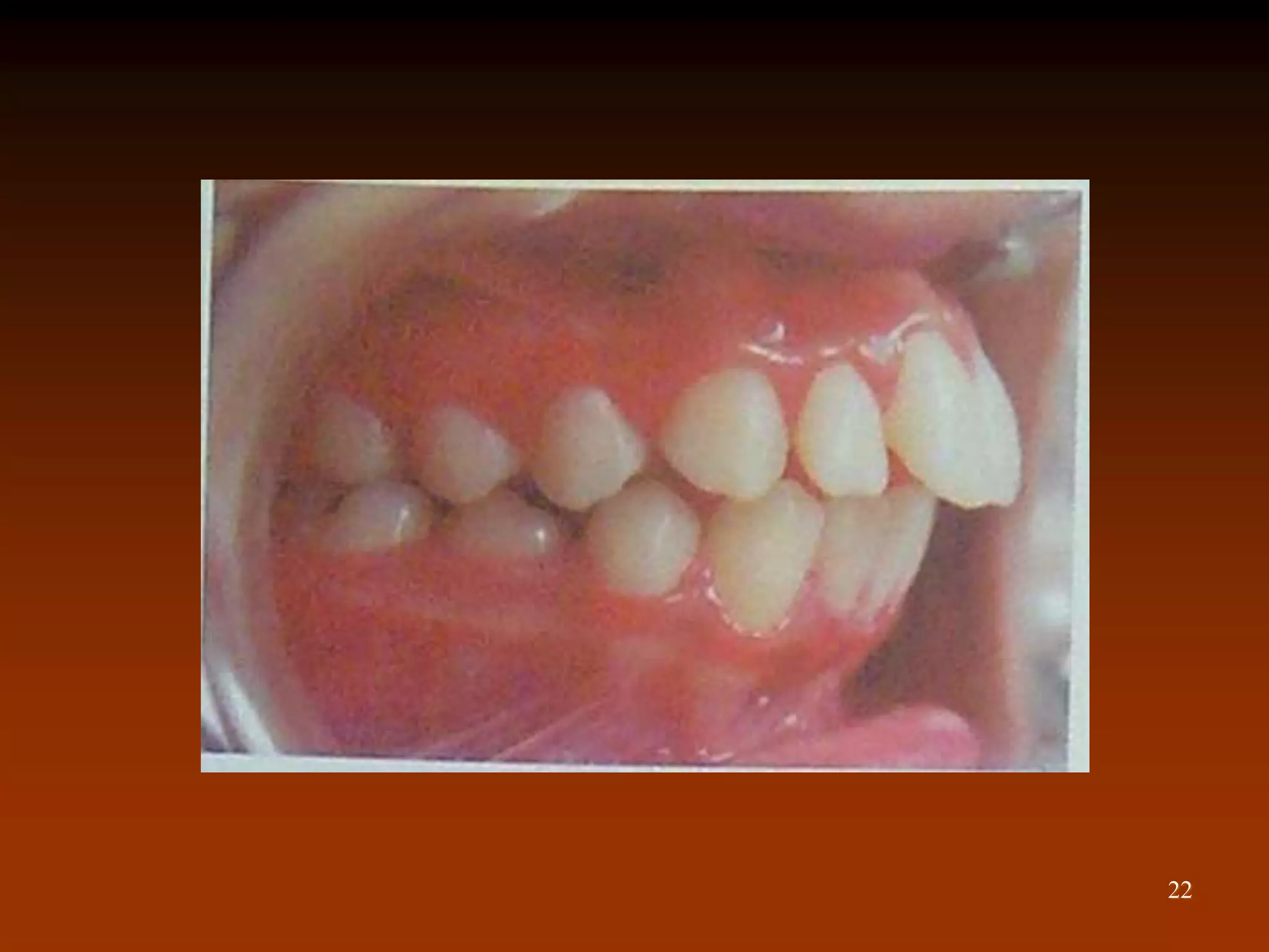 Classification-of-Malocclusion O.ppt